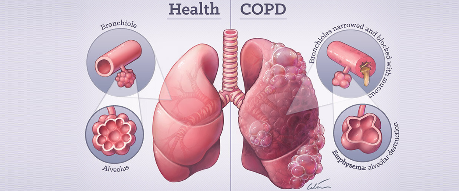 Know the Warning Signs: COPD Stages Revealed Guide